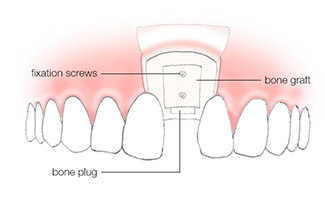Bone Grafting FAQ / Brener Clinic Sydney (North Sydney)